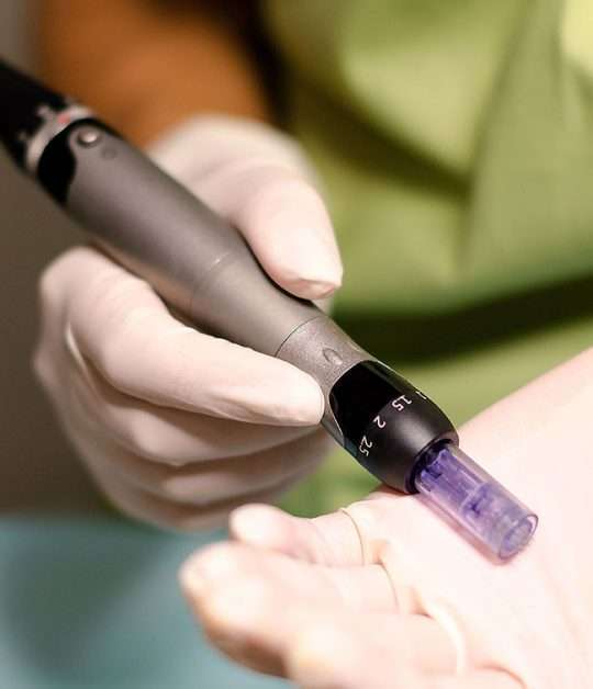 Platelet Rich Plasma Dark Circles - Laser & Beauty Aesthetics by Shiela ...