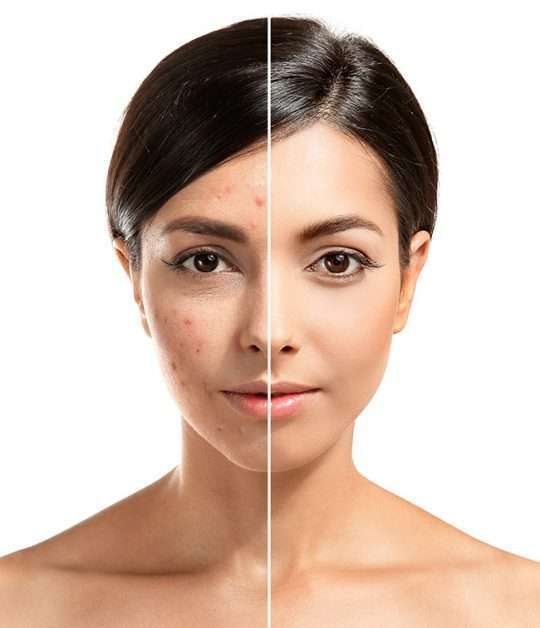 Skin Blemishes - Laser & Beauty Aesthetics by Shiela