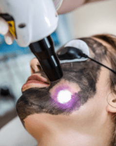 Laser Carbon Peel - Laser & Beauty Aesthetics by Shiela
