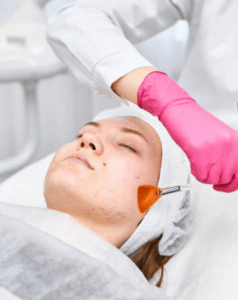 Combination Peel with Mplus - Laser & Beauty Aesthetics by Shiela