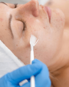 Combined Depigmenting Peel - Laser & Beauty Aesthetics by Shiela