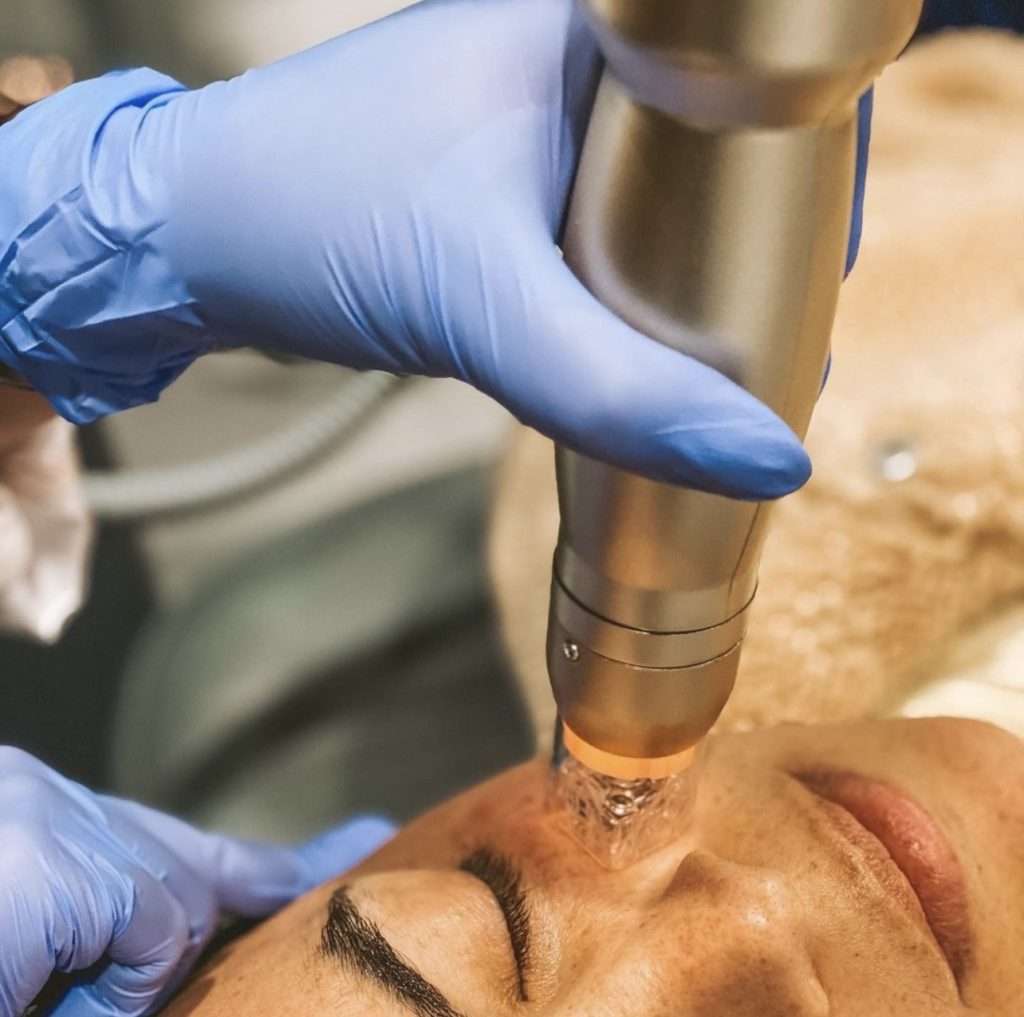 Radiofrequency Microneedling - Laser & Beauty Aesthetics by Shiela